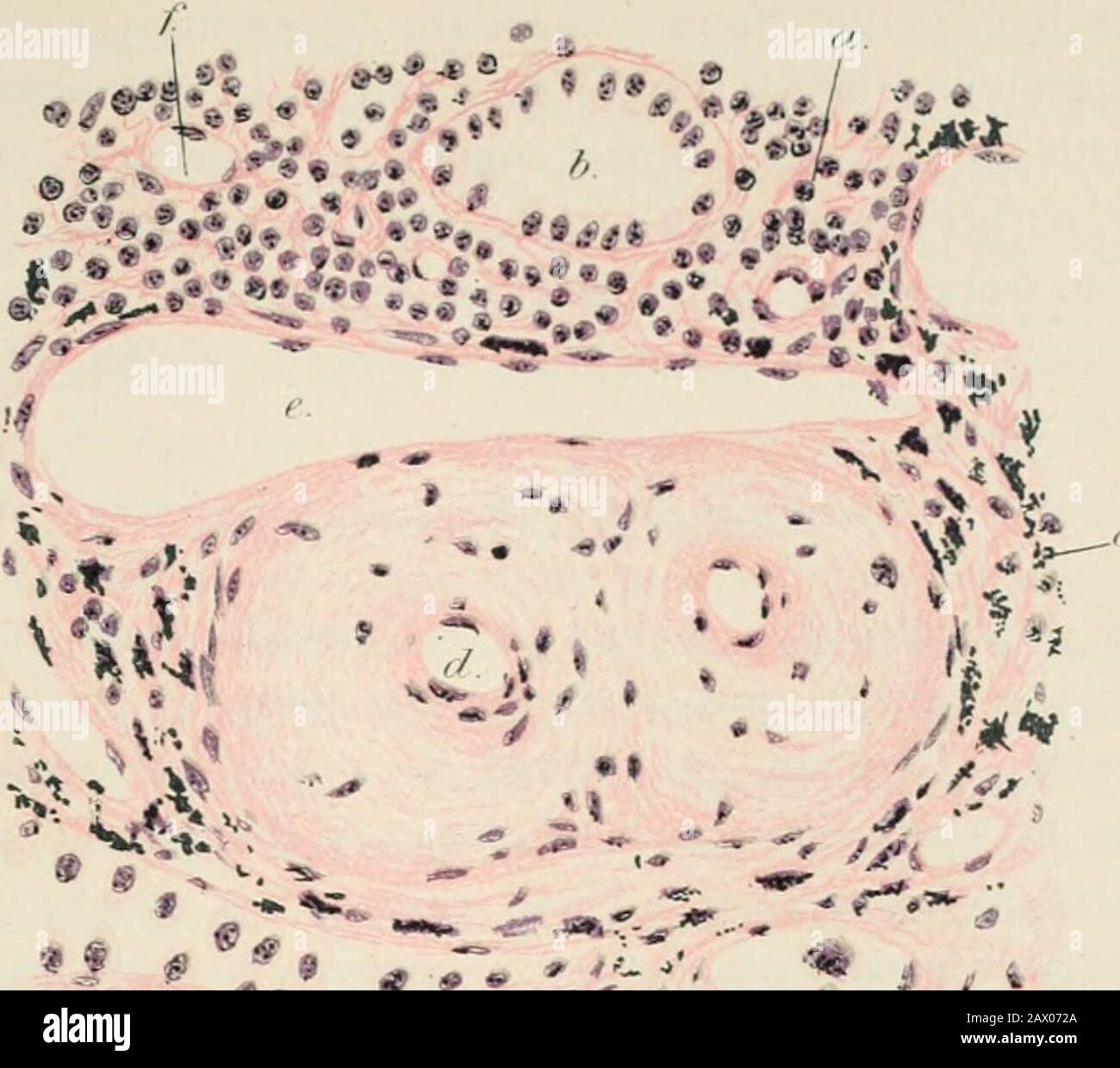 Endarteritis hi-res stock photography and images - Alamy