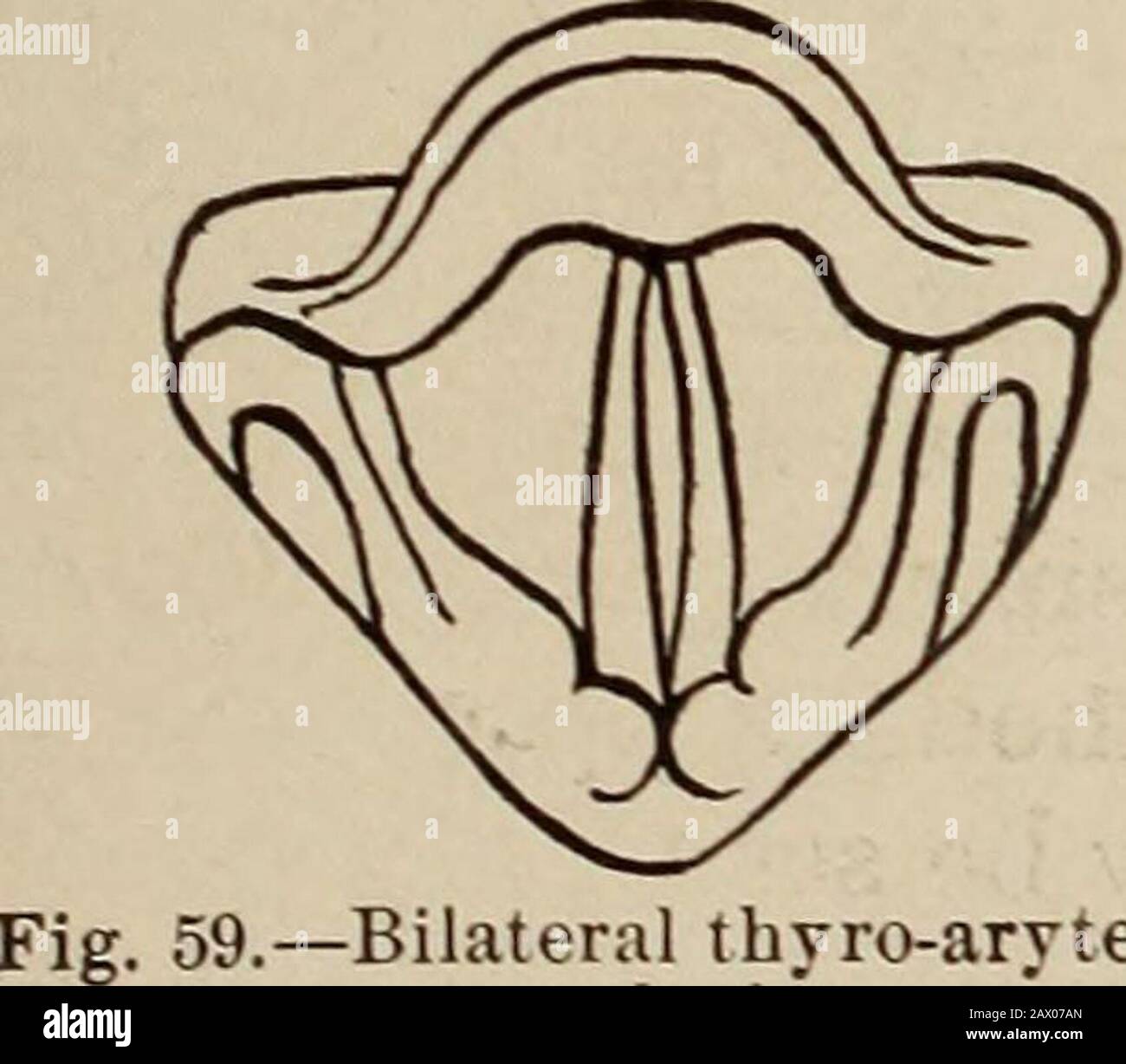 Nervous and mental diseases . Fig. 57.—Left abductor paraly-sis. Deep ...