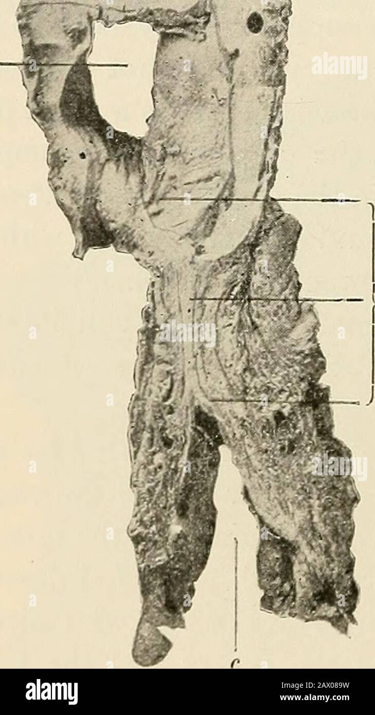 The pathology and surgical treatment of tumors . le involution of the ...