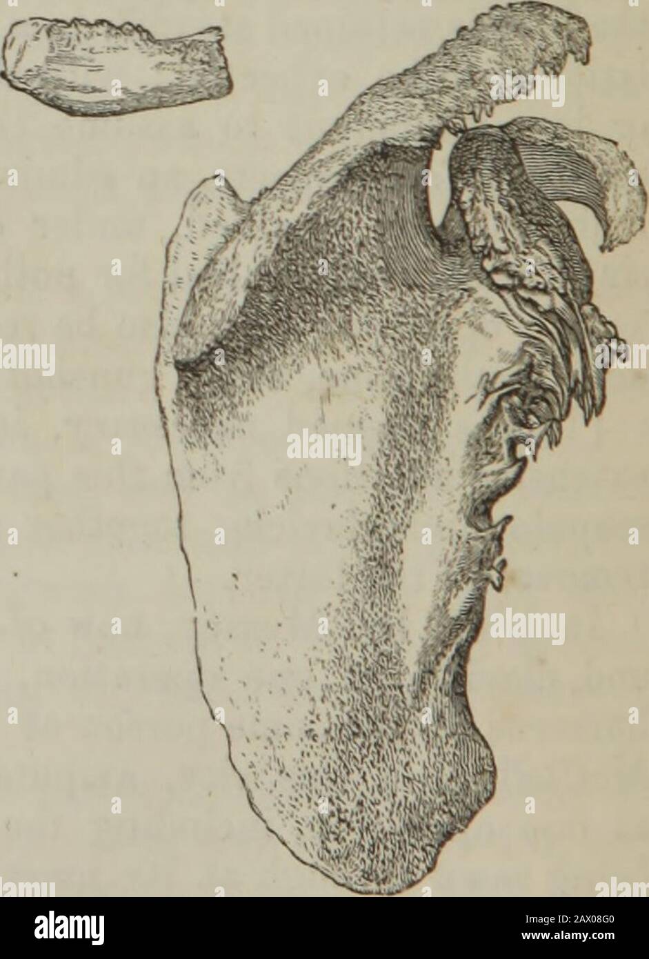 Clavicle resection hi-res stock photography and images - Alamy