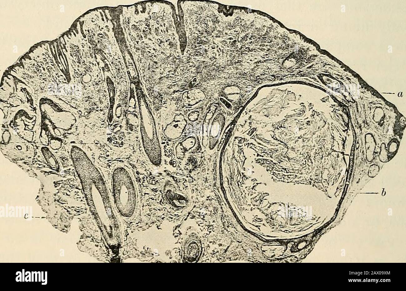 The pathology and surgical treatment of tumors . retention-cysts of the ...