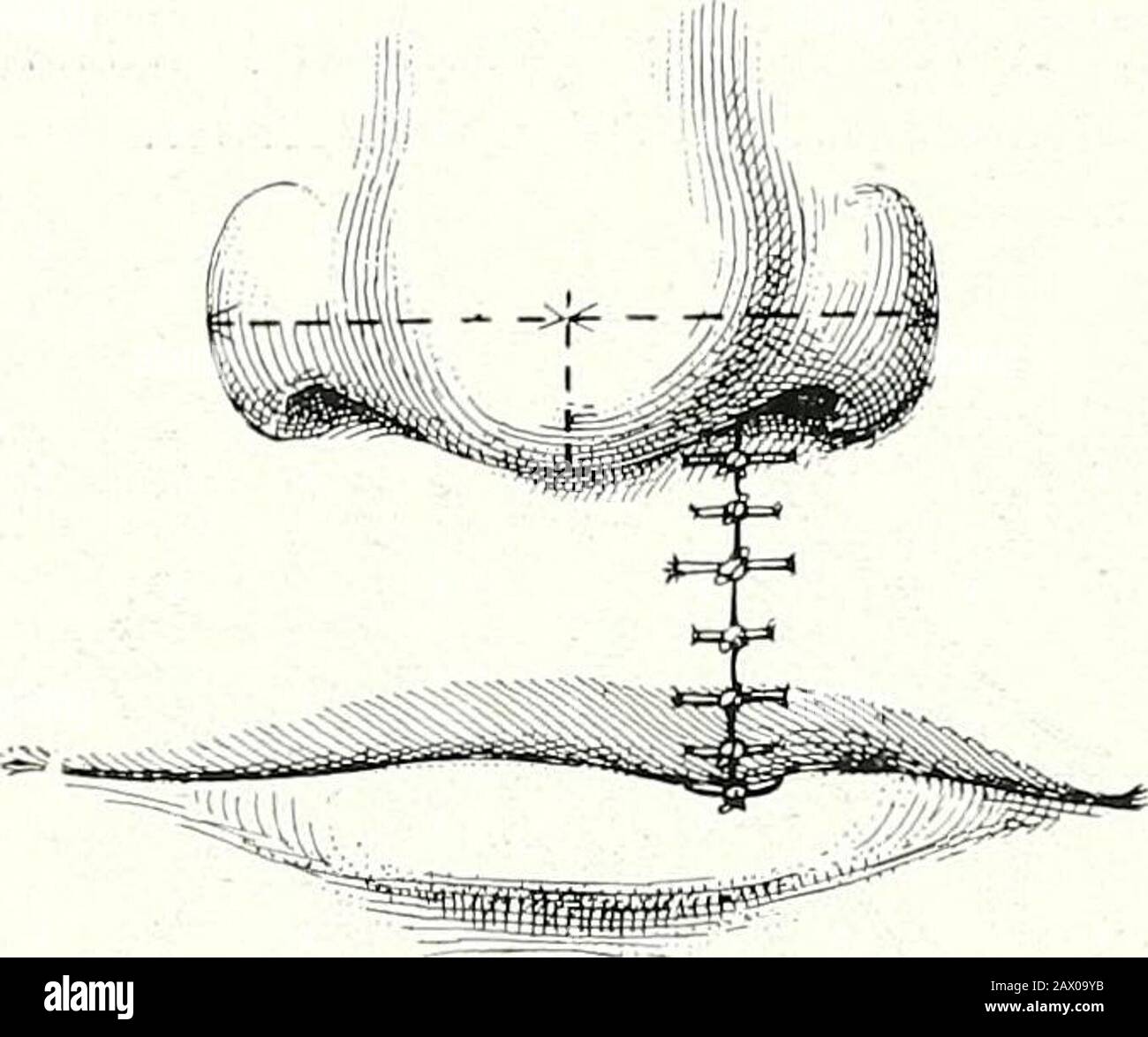 Soft palate deviation hi-res stock photography and images - Alamy