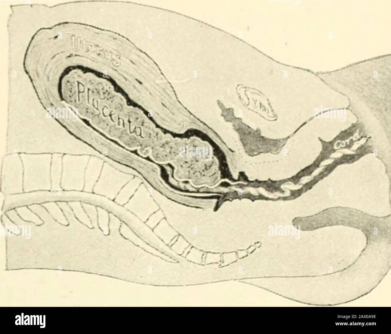 A textbook of obstetrics . kC* : ^ : it Fig. 259.—Credos method of ...