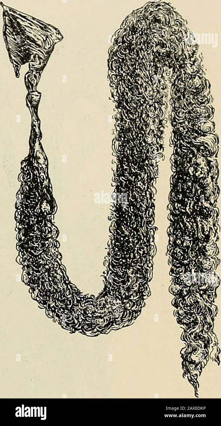 Dermoid cyst hi-res stock photography and images - Alamy