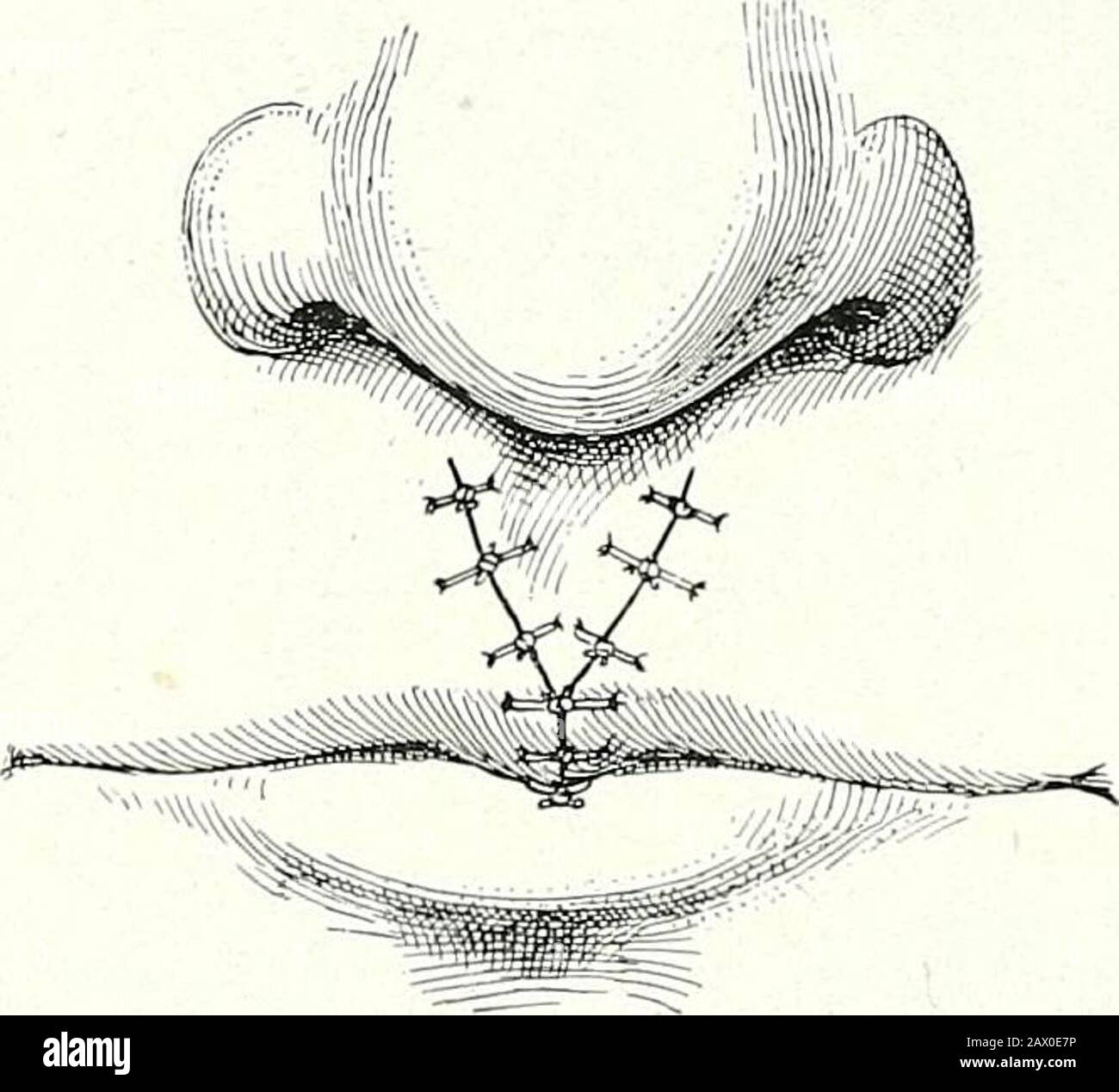 Hare lip hi-res stock photography and images - Alamy