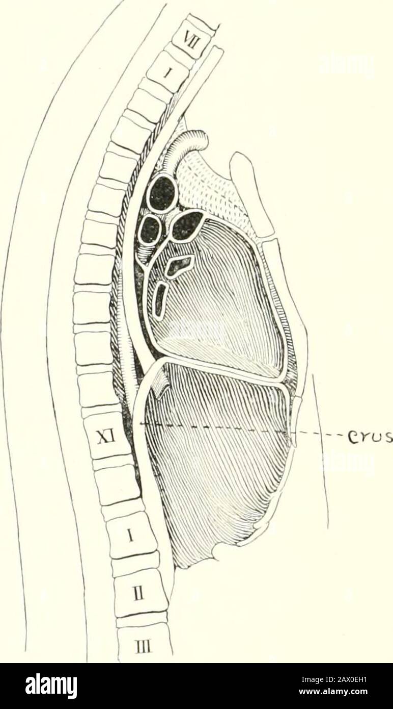 Clinical tuberculosis . Fig. 45.—Showing the movements of the diaphragm ...