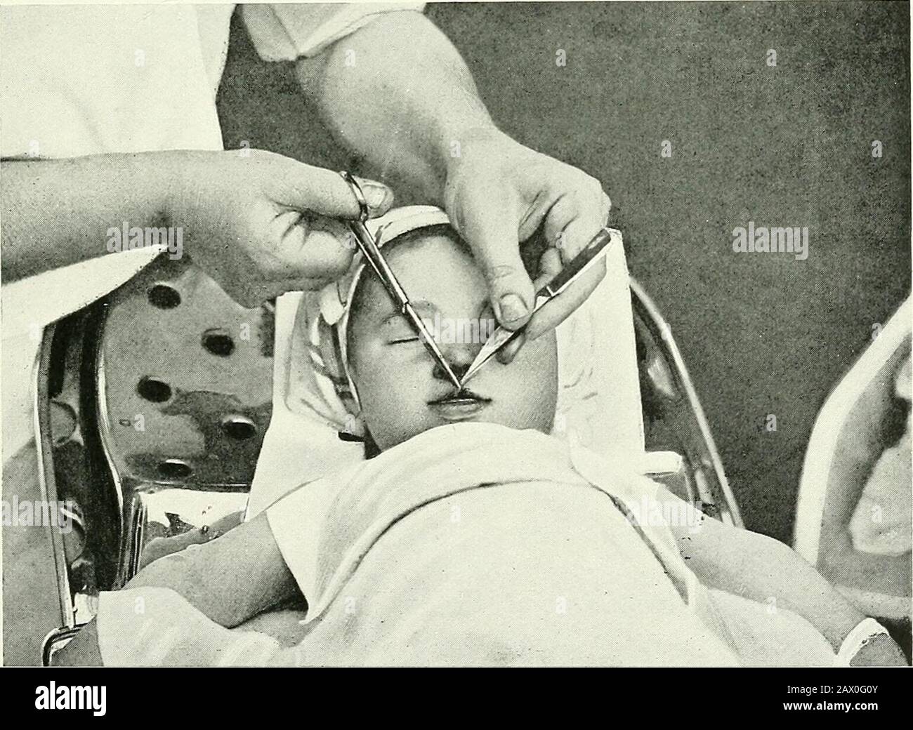 Surgical therapeutics and operative technique . Fig. 13.—Simple ...