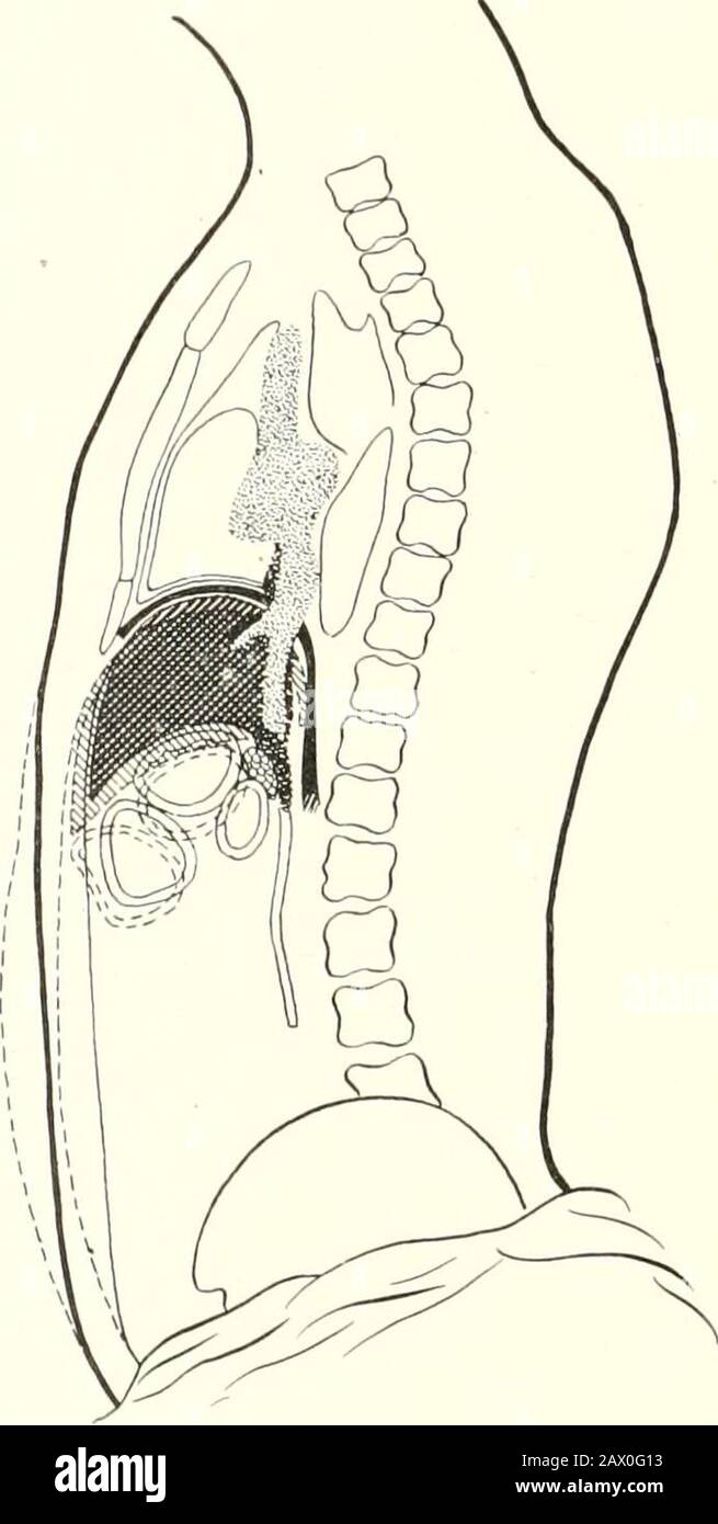 Clinical tuberculosis . Fig. 43.—Showing the movements of .he diaphragm ...