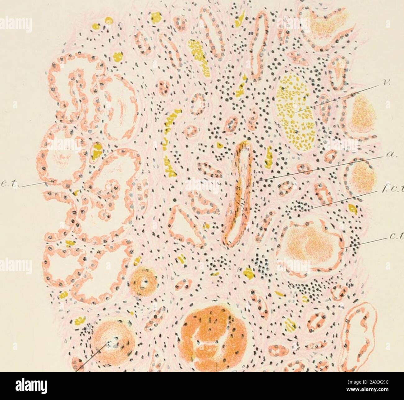 Endarteritis High Resolution Stock Photography and Images - Alamy