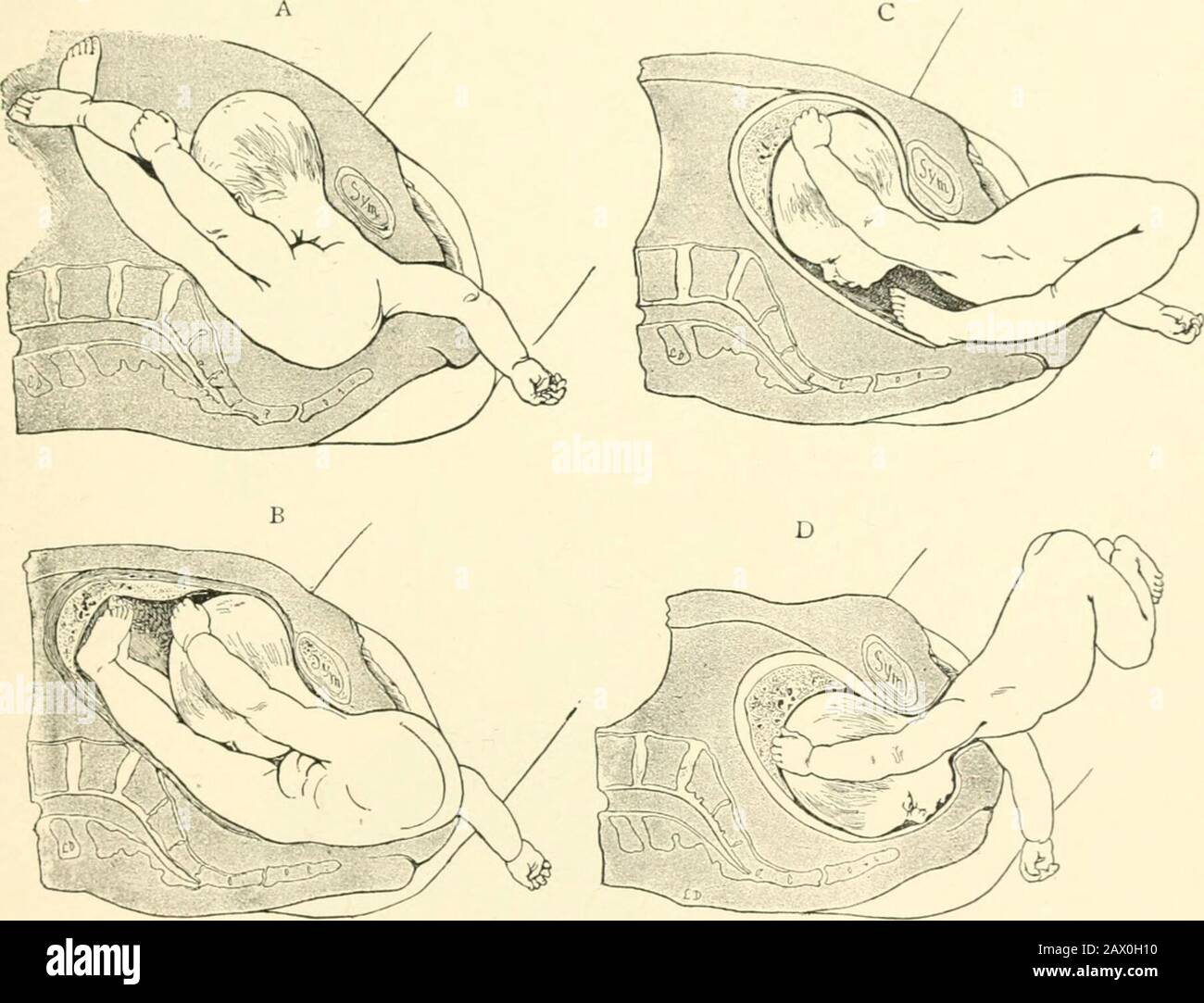 A textbook of obstetrics . Fig. 253. Presentation I the umbili ...