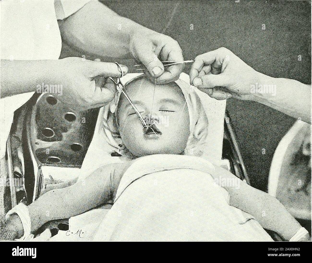 Surgical therapeutics and operative technique . Fig. 10.—Simple ...