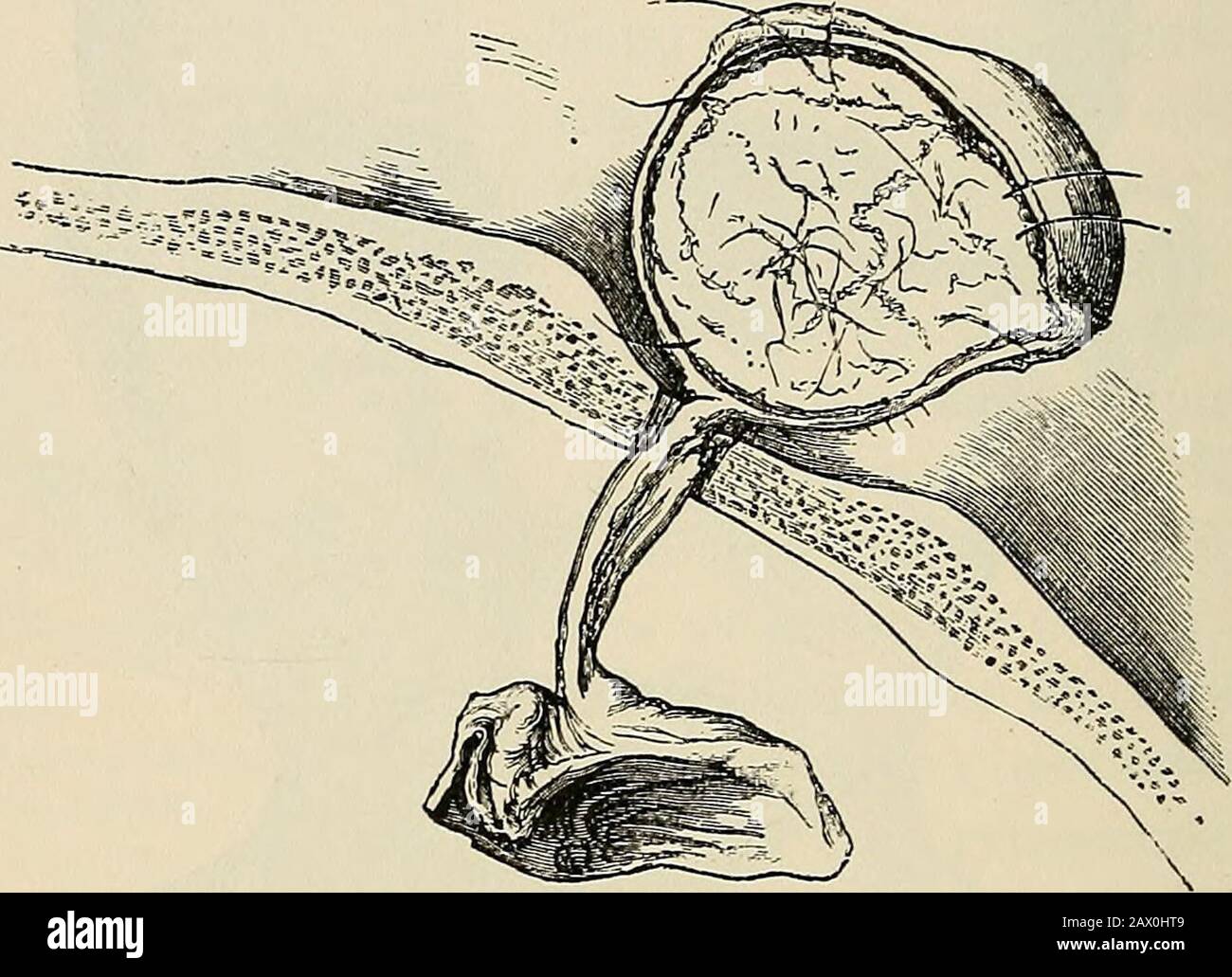 The pathology and surgical treatment of tumors . Fig. 459.—Pedunculated ...