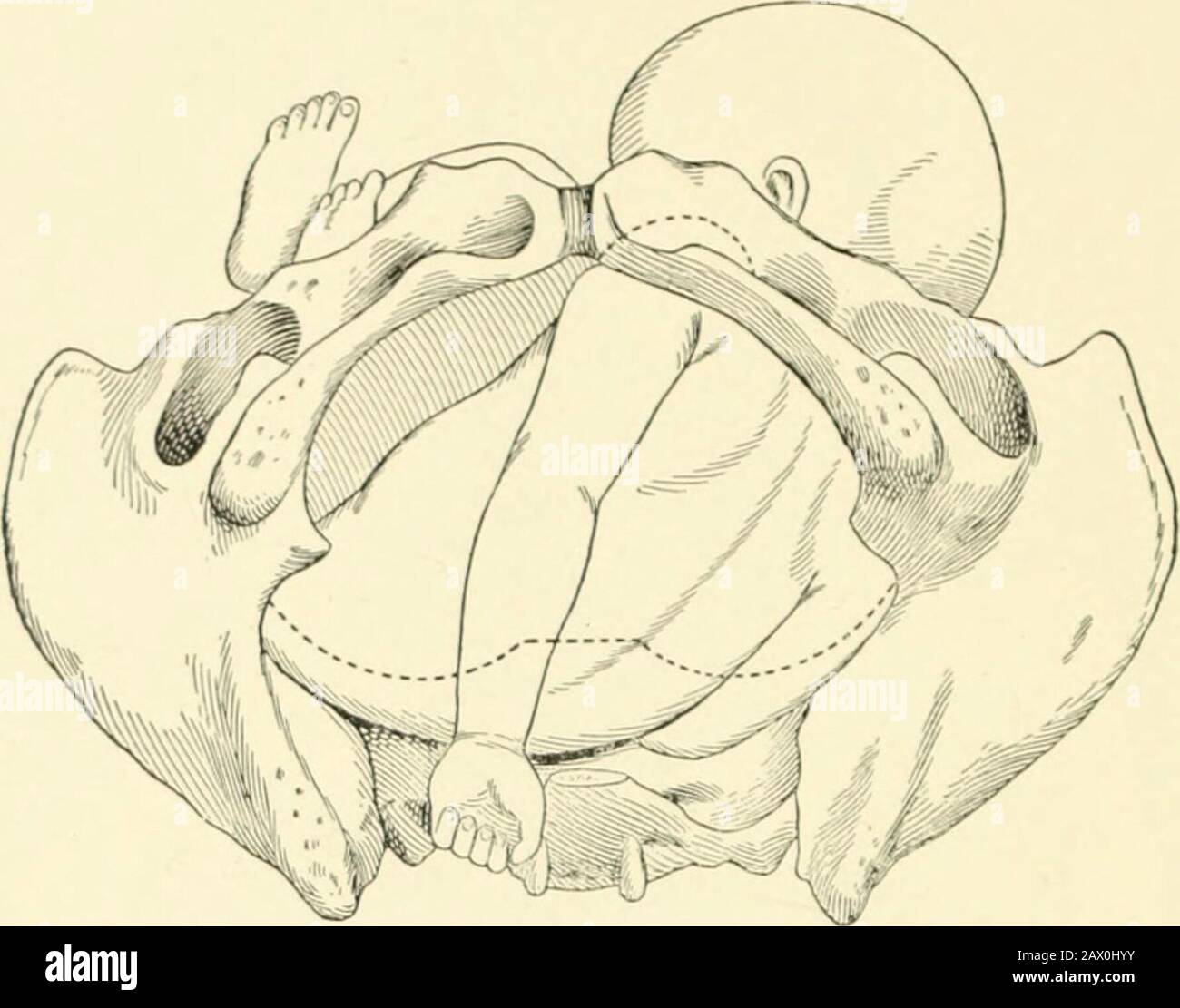 A textbook of obstetrics . Fig. 250.—Back presentation;the left arm is ...