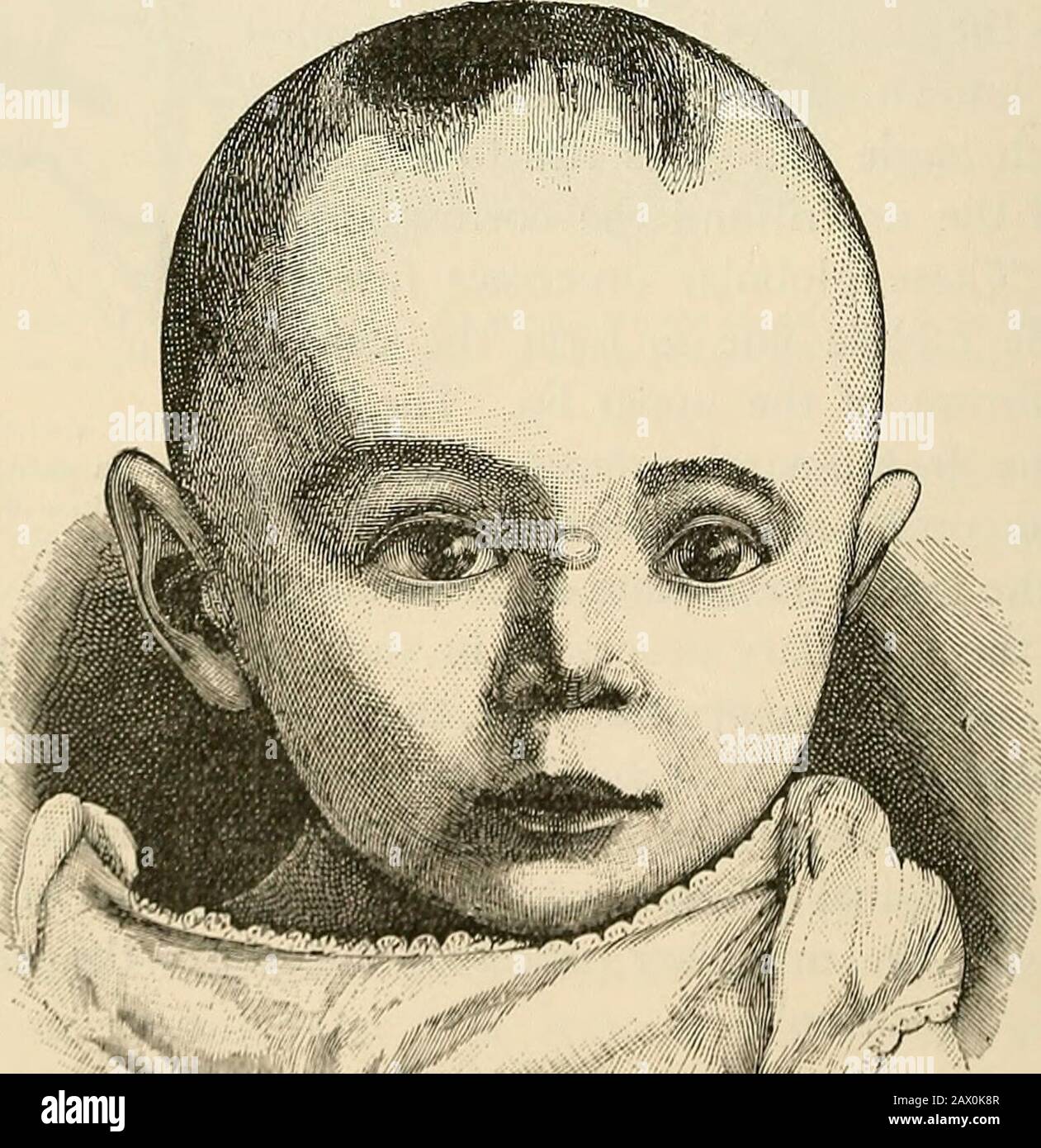 The pathology and surgical treatment of tumors . Fig. 456.—Dermoid at ...