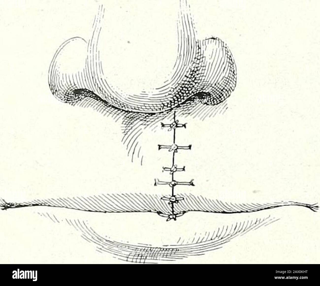 Surgical therapeutics and operative technique . Fig. 5.—Simple Hare-Lip ...
