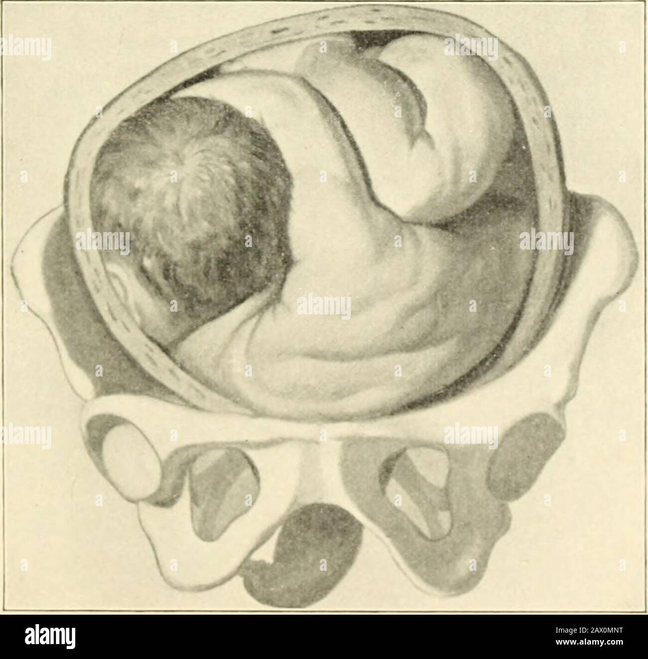 A textbook of obstetrics . Fig. 245. — Shoulder presentation.. Fig. 246 ...