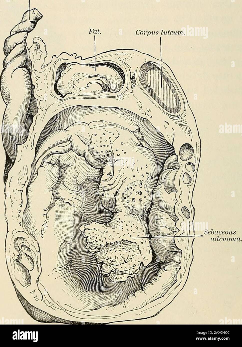 Dermoid Cyst Ovary Eye