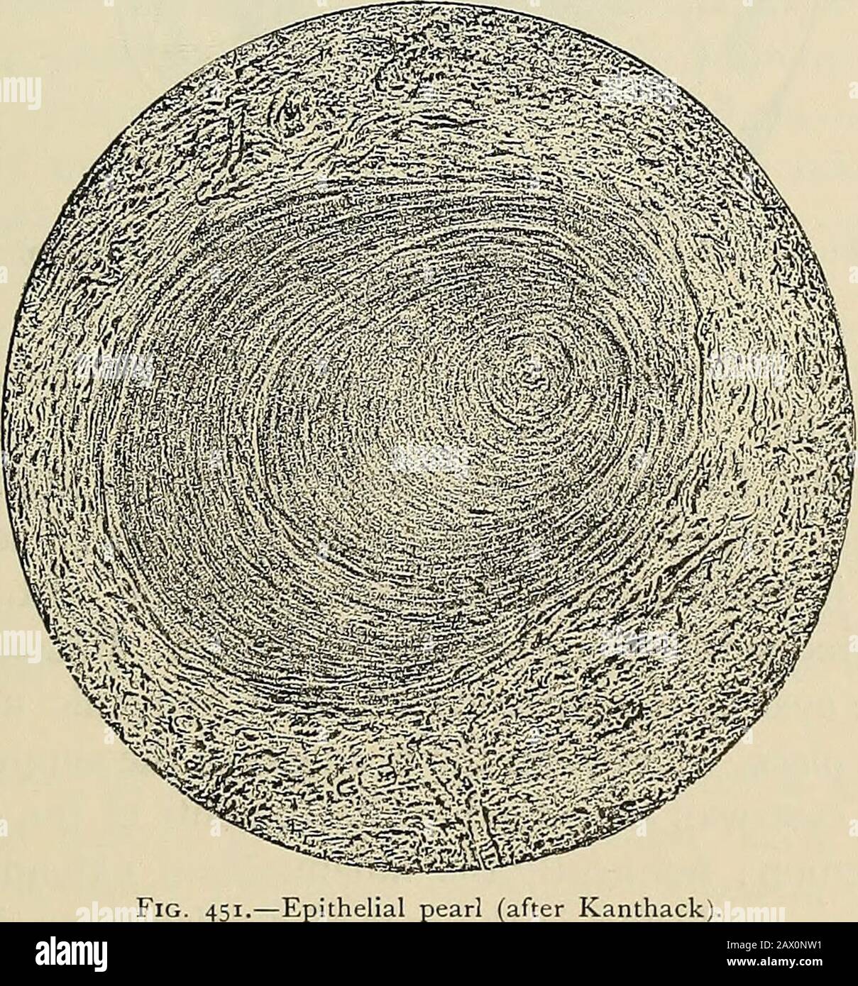The pathology and surgical treatment of tumors . Epithelial pearl ...