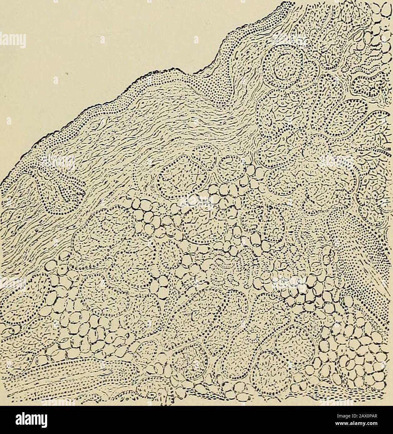 Sebaceous cysts hi-res stock photography and images - Alamy