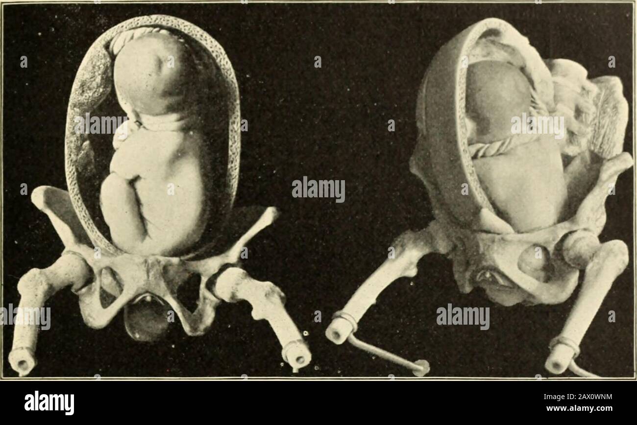 Breech Presentation Longitudinal Lie