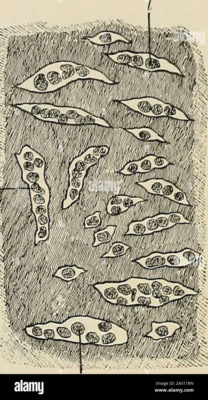 The pathology and surgical treatment of tumors . Fig. 433.—Sarcoma of ...