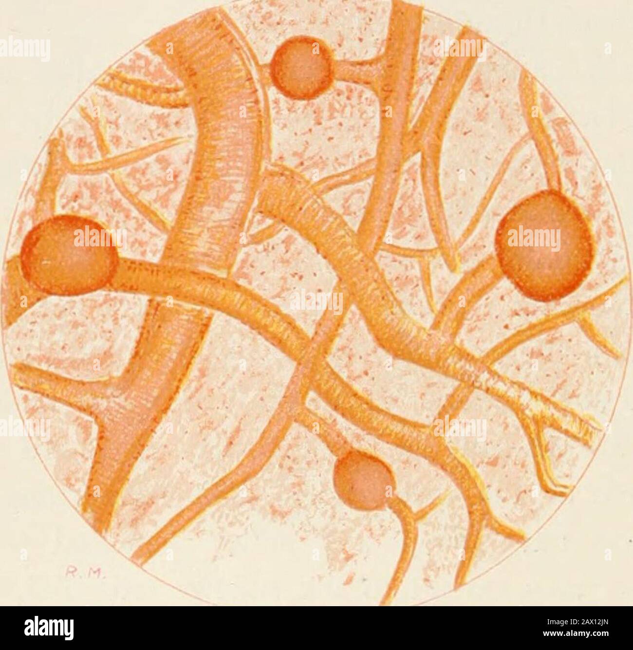 Interstitial lung disease hi-res stock photography and images - Alamy