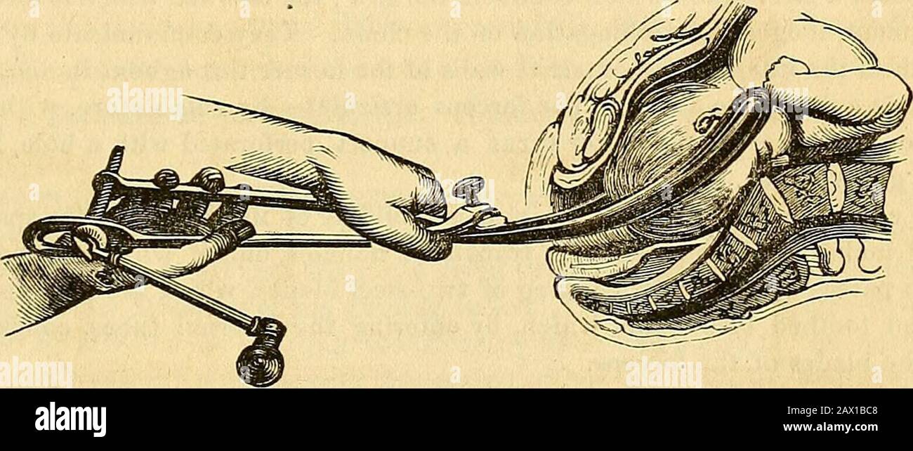 A theoretical and practical treatise on midwifery : including the ...