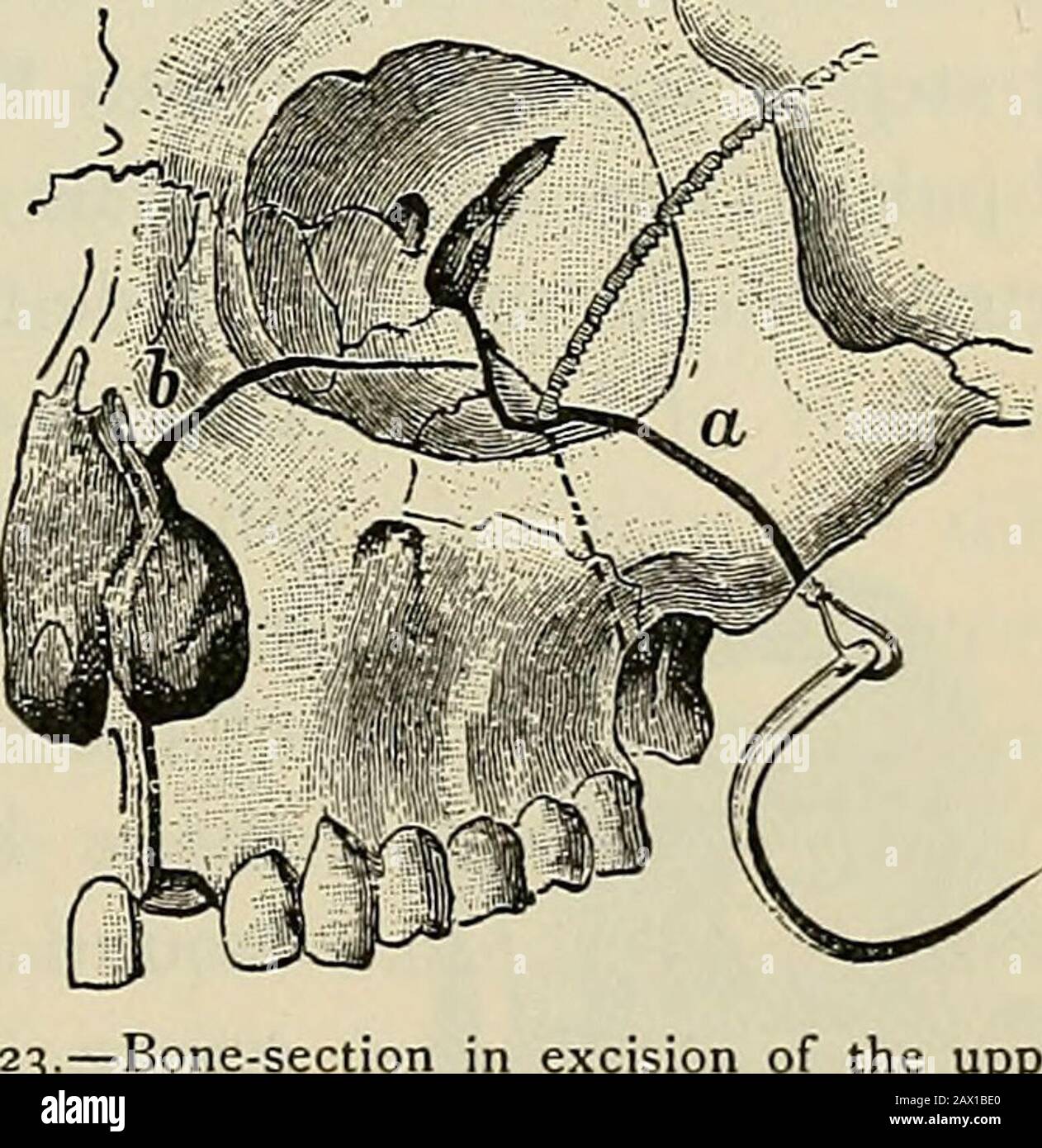 The pathology and surgical treatment of tumors . Fig. 422.—Webers ...