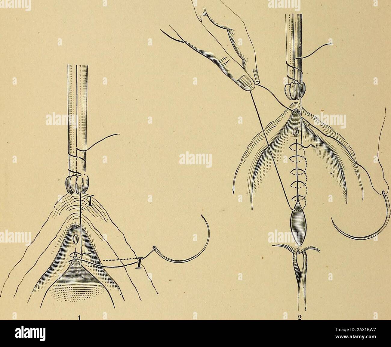 Surgical knots hi-res stock photography and images - Alamy