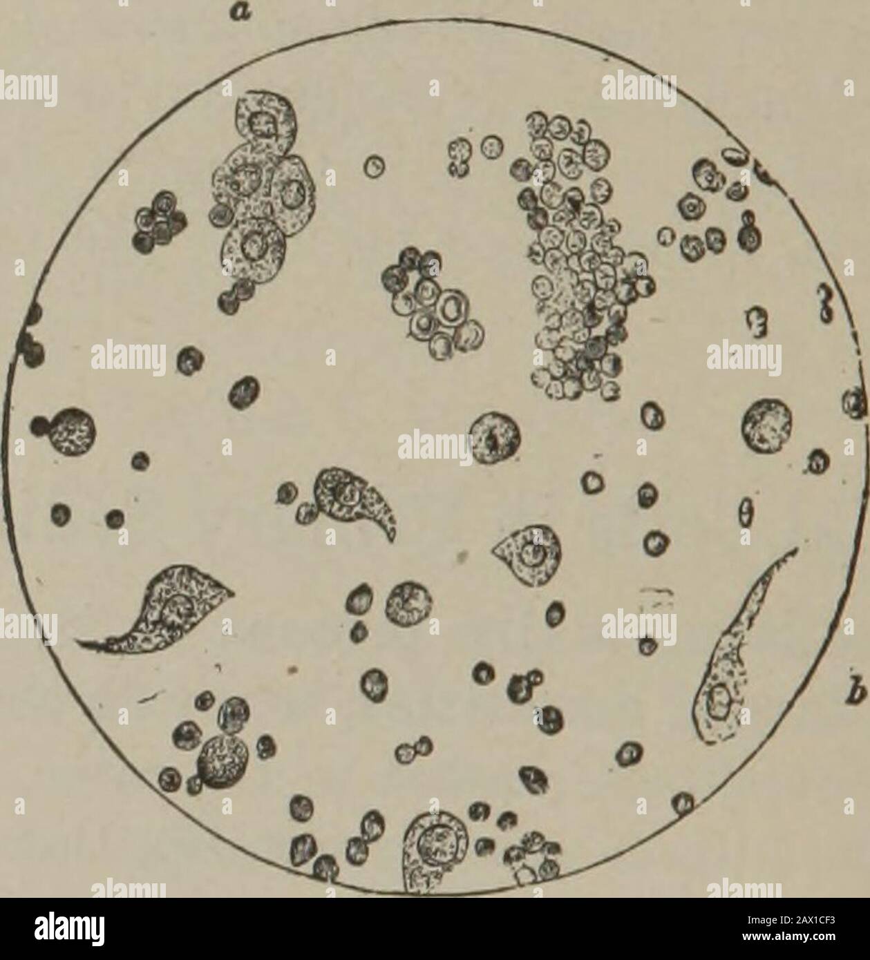 Caudate Transitional Epithelial Cells In Urine Sediment FUS Series Of