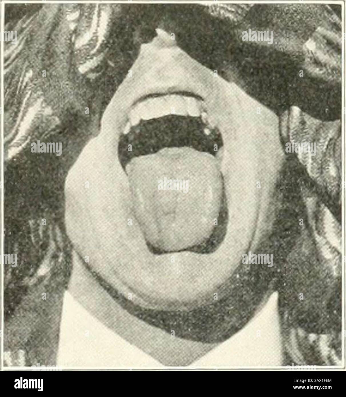 Clinical tuberculosis . Fig. 11.—Illustrating tuberculous lesions of ...