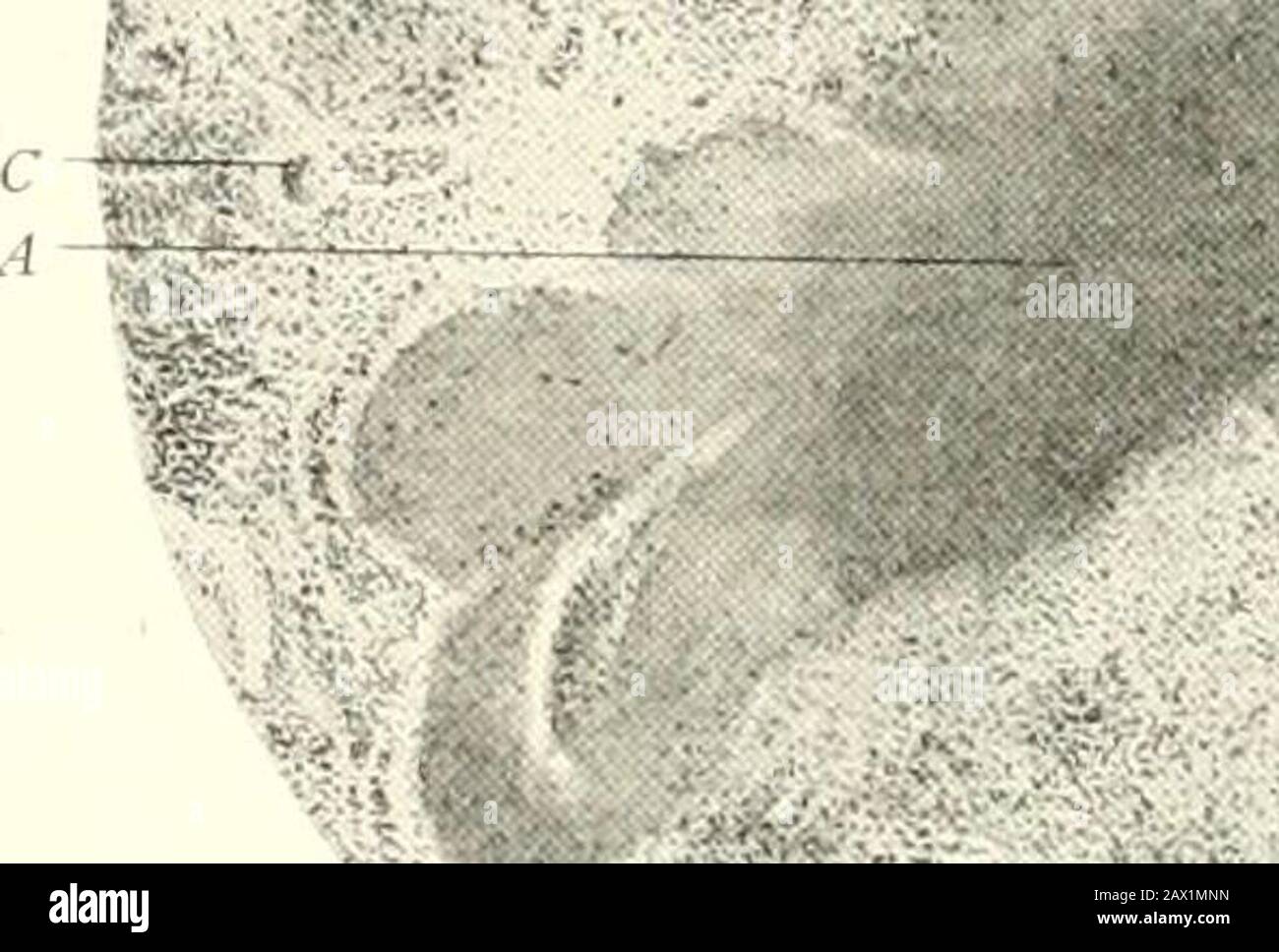Tubercle Tuberculosis