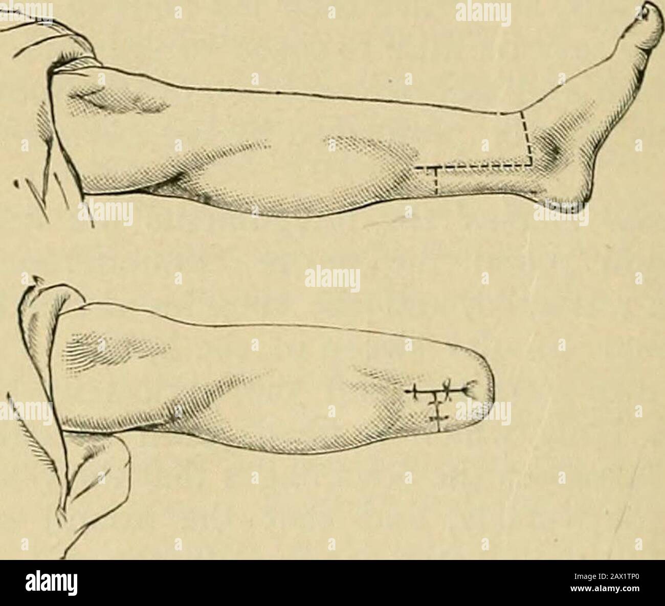 Only lateral position hi-res stock photography and images - Alamy