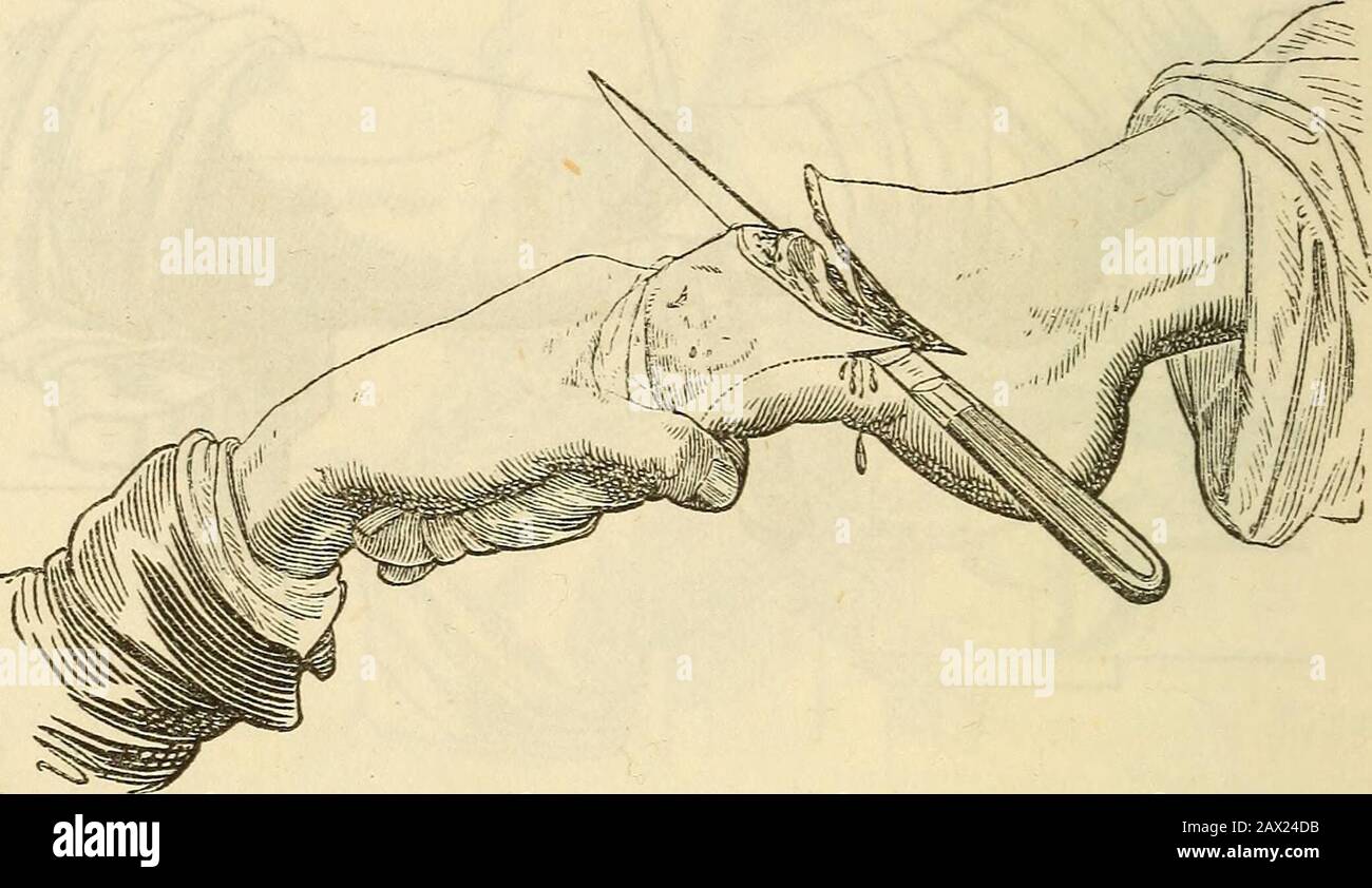 Choparts amputation hi-res stock photography and images - Alamy