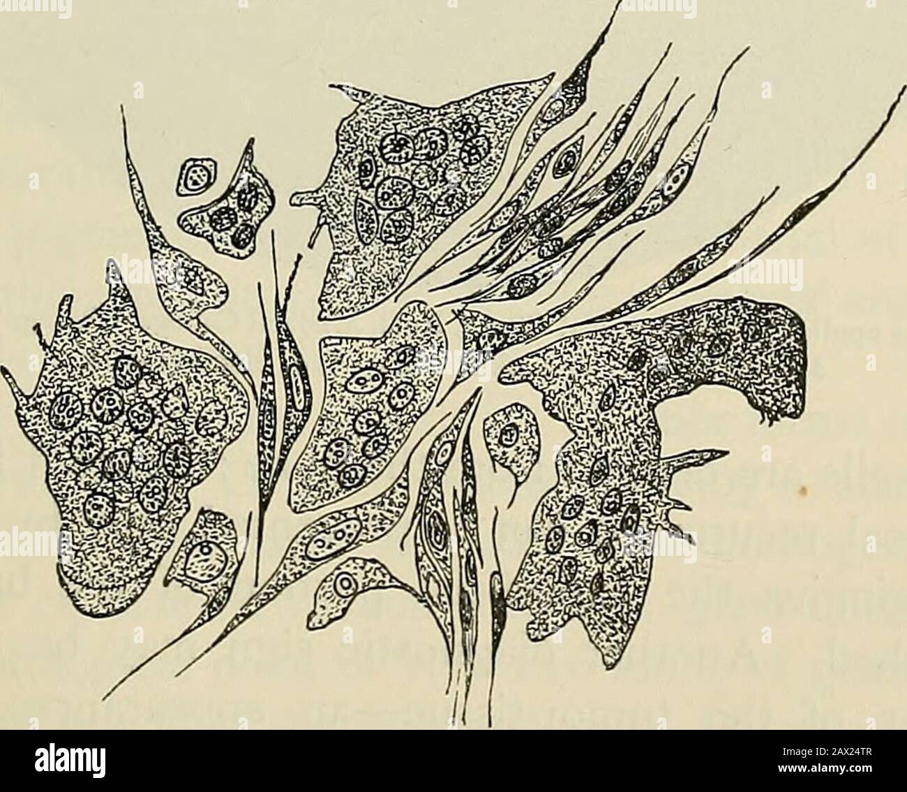 The pathology and surgical treatment of tumors . ofconnective-tissue ...