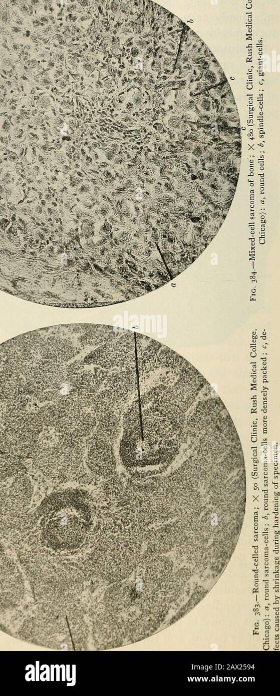 The pathology and surgical treatment of tumors . SC.S^. SARCOMA. 537 ...
