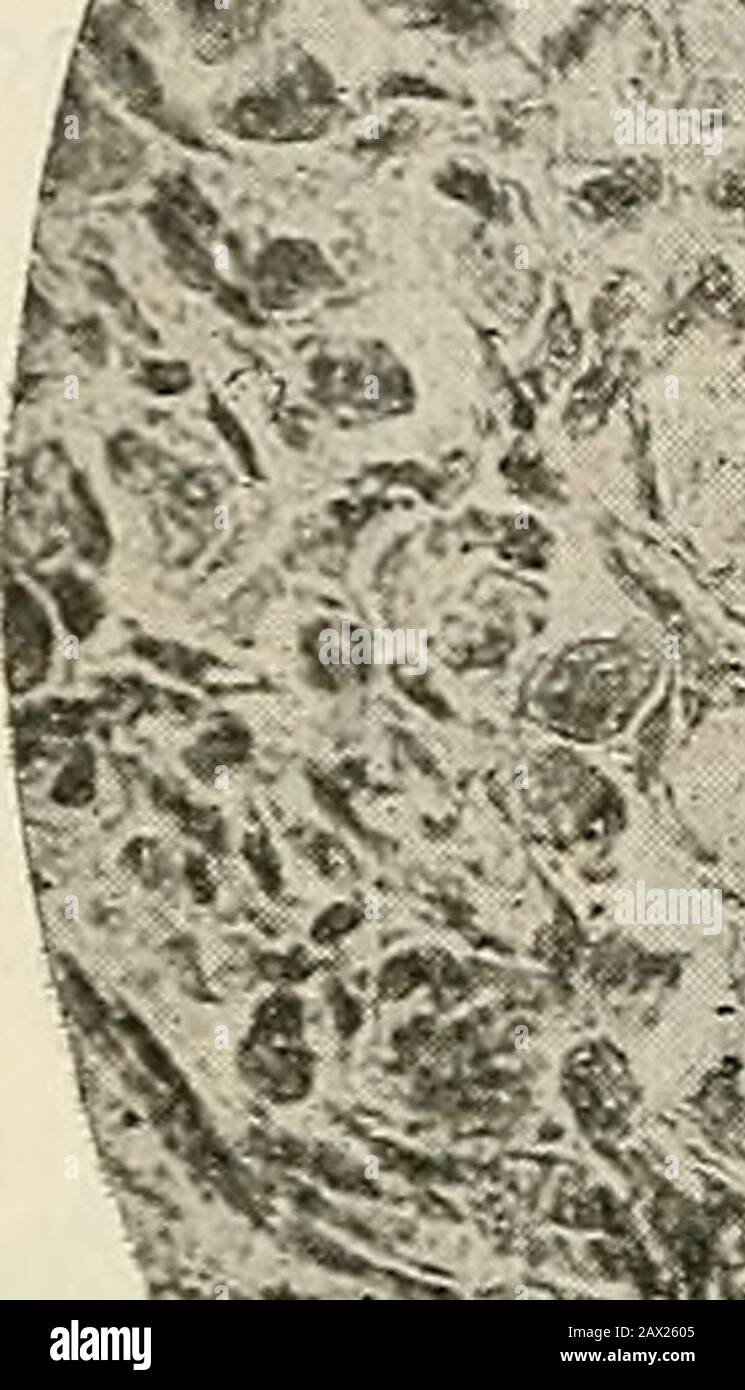 Soft tissue sarcoma hi-res stock photography and images - Alamy