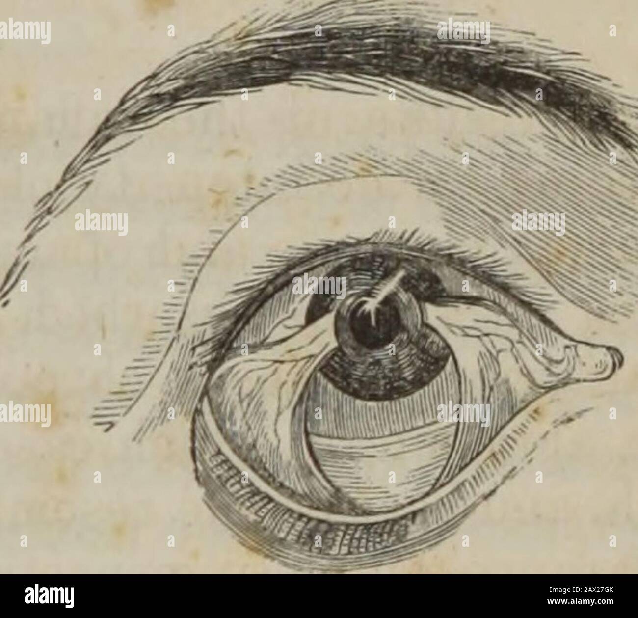 Pterygium hi-res stock photography and images - Alamy