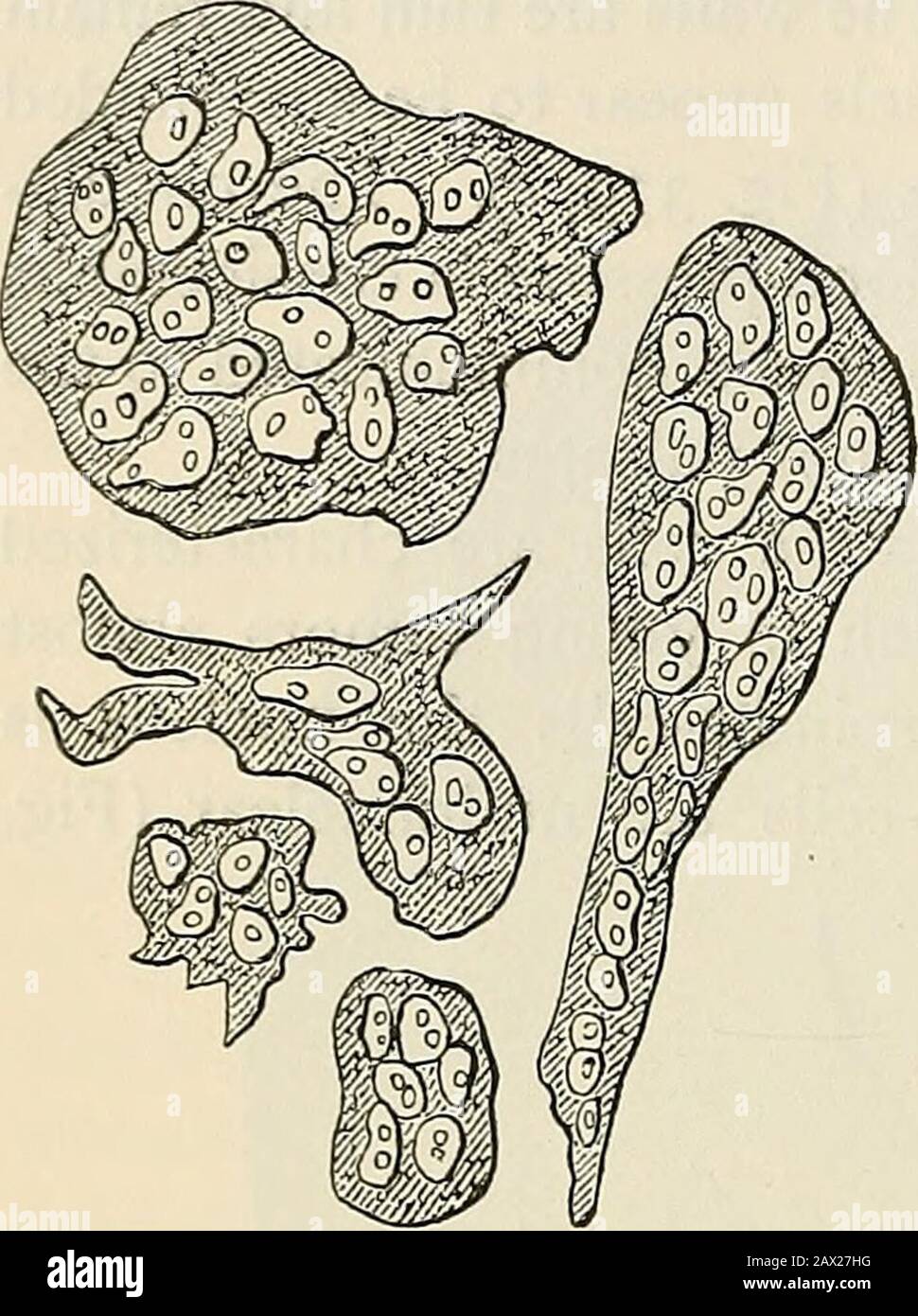 Spindle cell tumors hi-res stock photography and images - Alamy