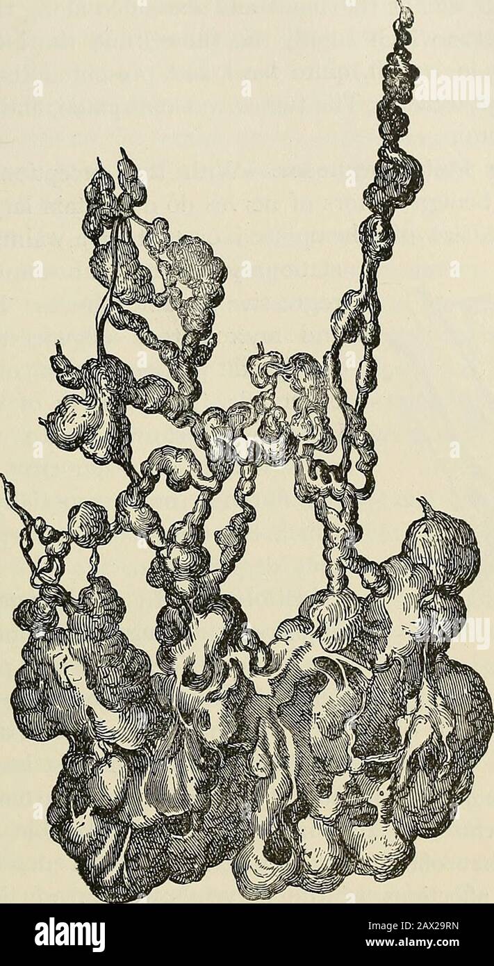 The pathology and surgical treatment of tumors . Fig. 372.—Miliary ...