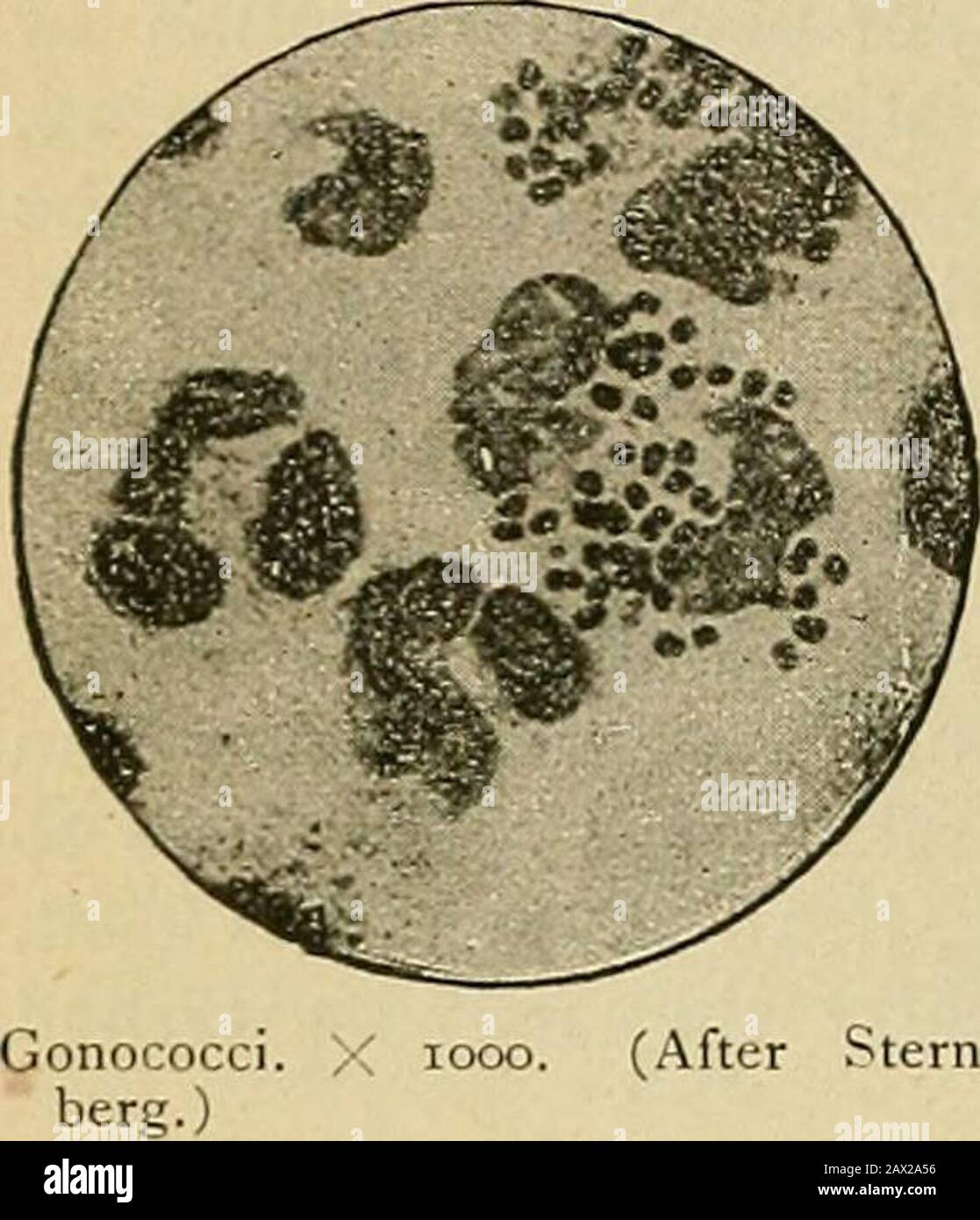 Surgery; its theory and practice . by a catarrhal, and at times by a ...