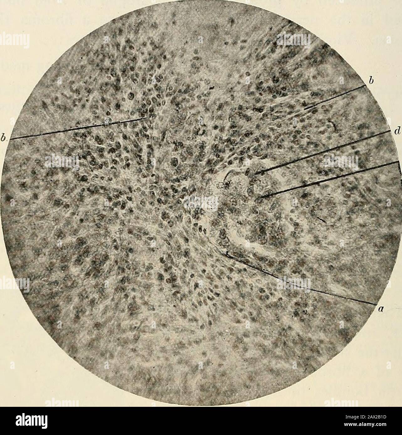 The pathology and surgical treatment of tumors . 369.—Portion of a ...