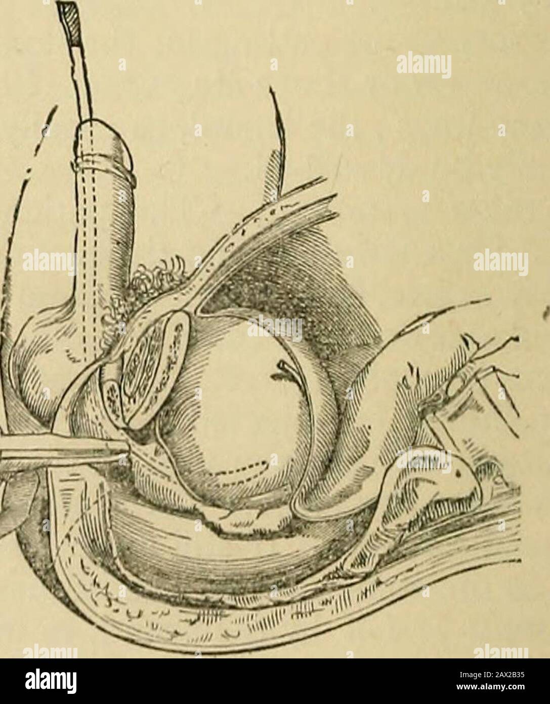 Surgery; its theory and practice . Parts cut in lithotomy. (Fergusons ...