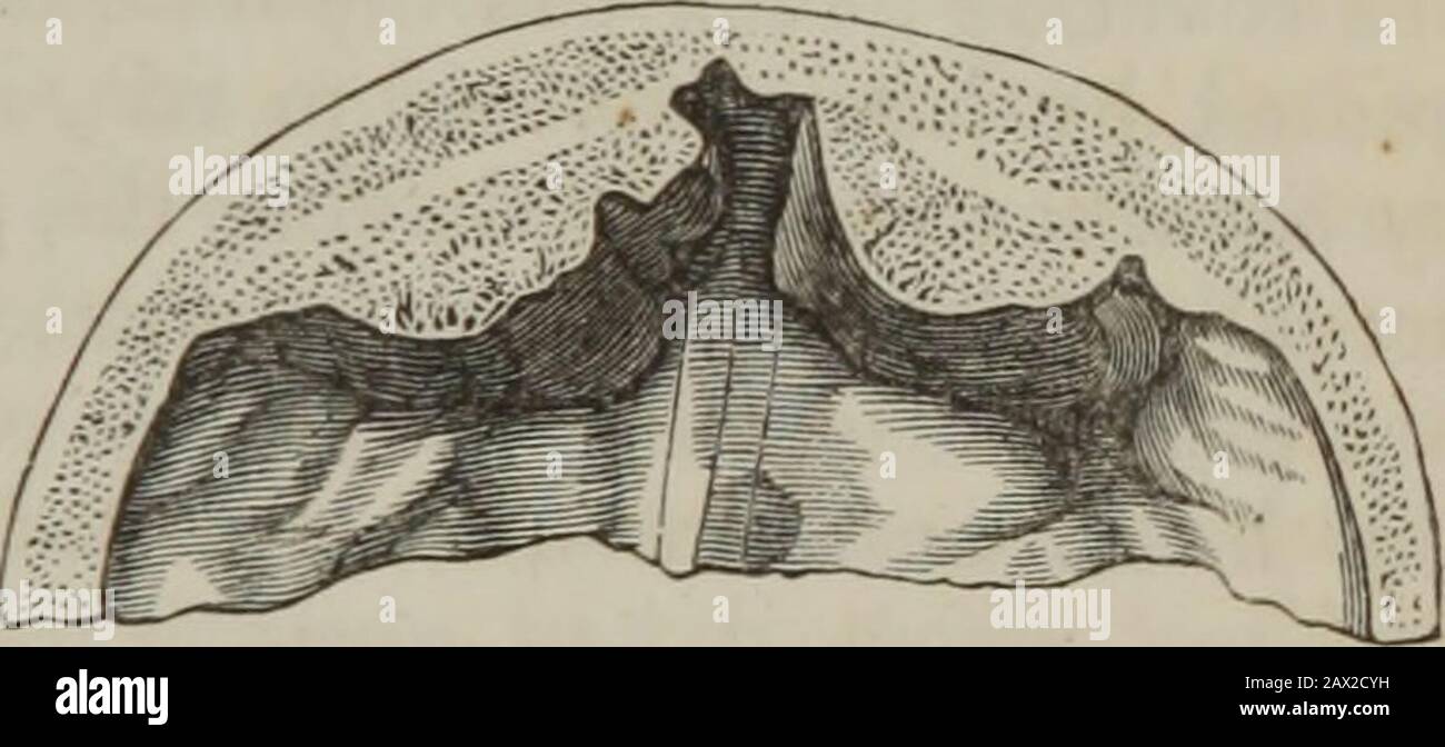 The practice of surgery . Large Internal Exostoses. Large Exostoses of ...