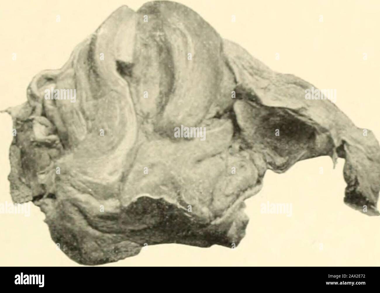 Decidua reflexa hi-res stock photography and images - Alamy