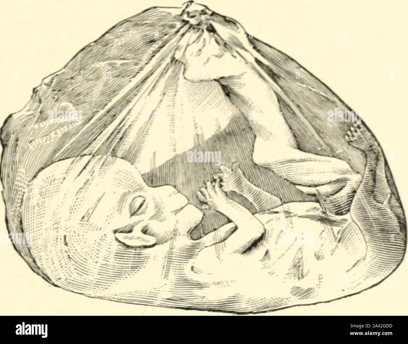 A textbook of obstetrics . Fig. 154.—Thickened decidua,forming cast of ...
