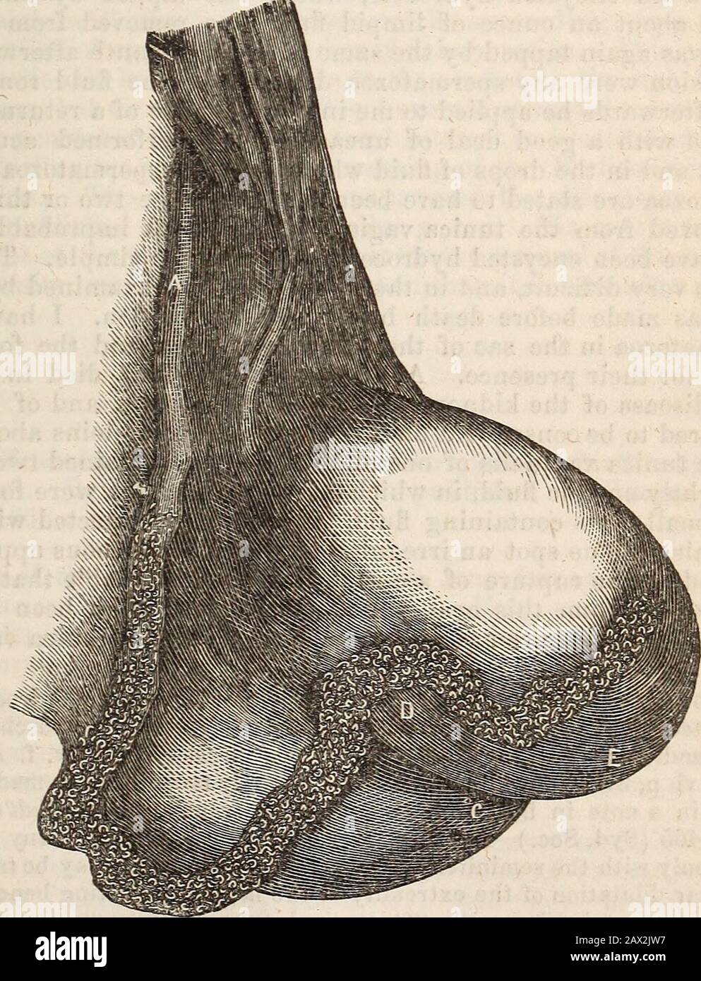 Hydrocele hi-res stock photography and images - Alamy