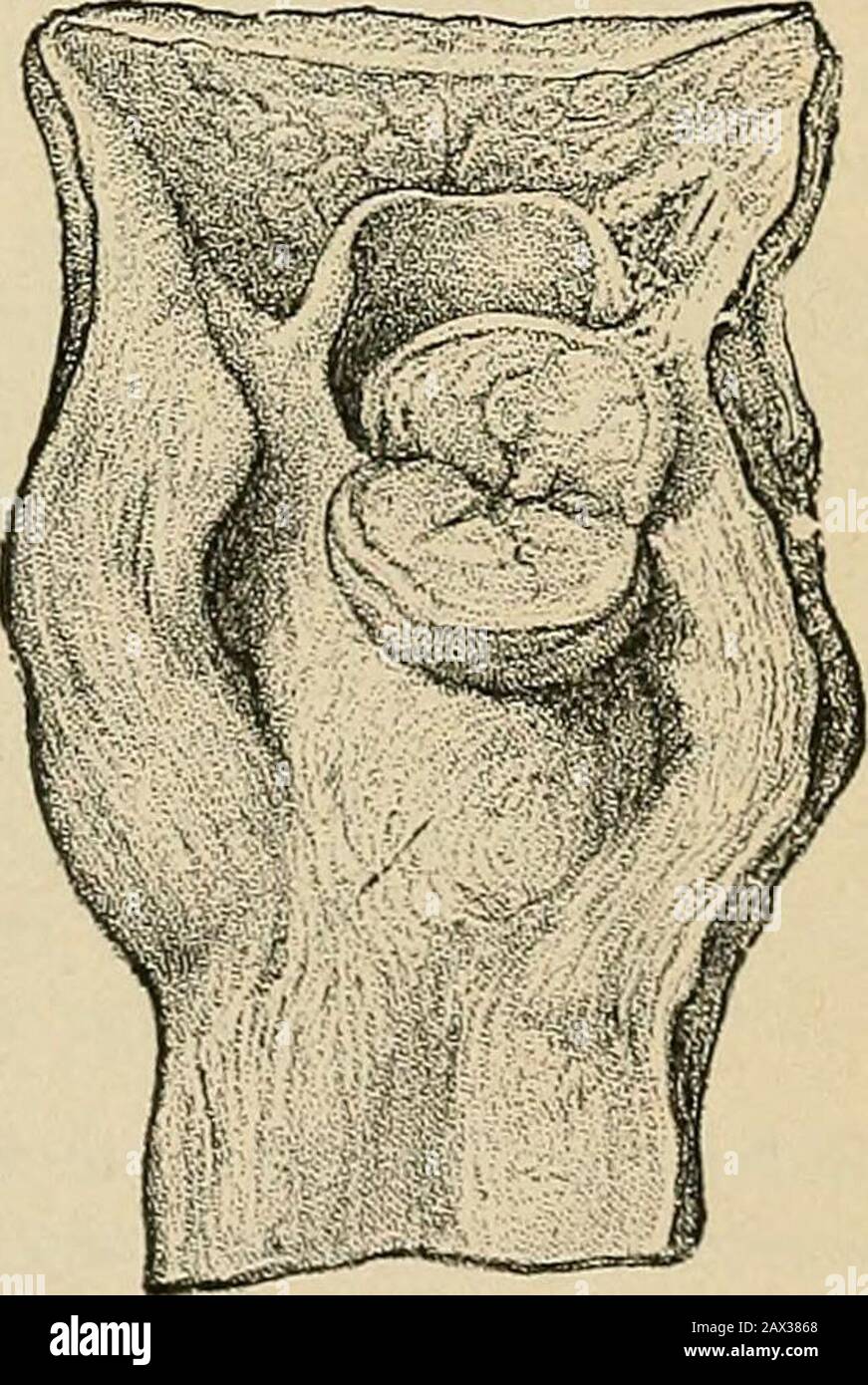 Surgery; its theory and practice . Papilloma of laryn.x. (St P ...