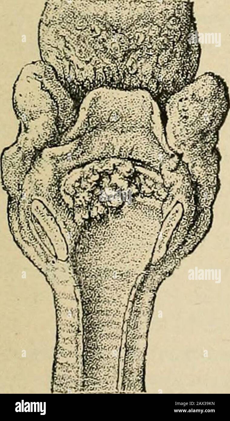 Gumma syphilis hi-res stock photography and images - Alamy