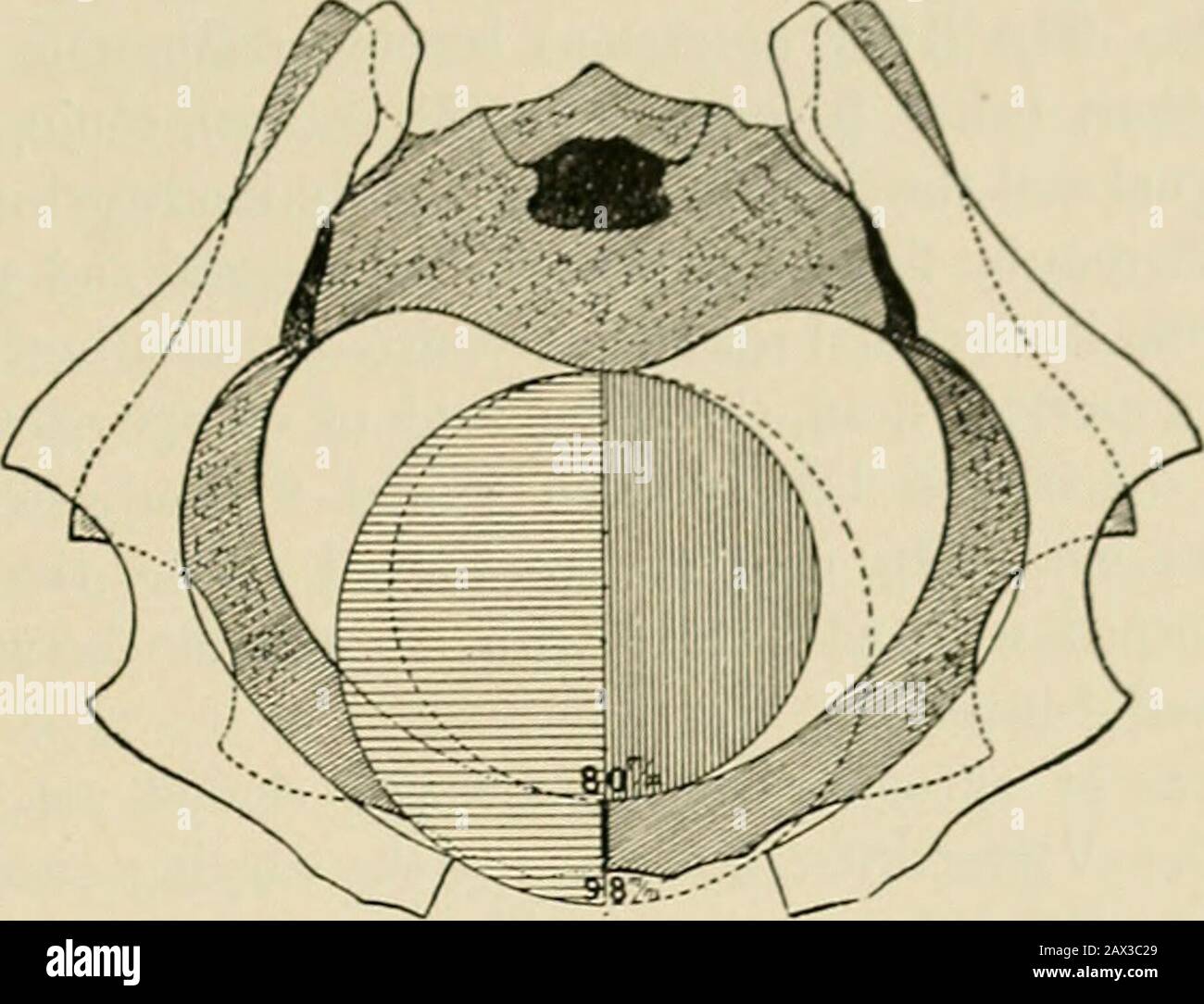 Symphysiotomy hi-res stock photography and images - Alamy